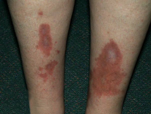 How Does Diabetic Skin Rash Look Like 